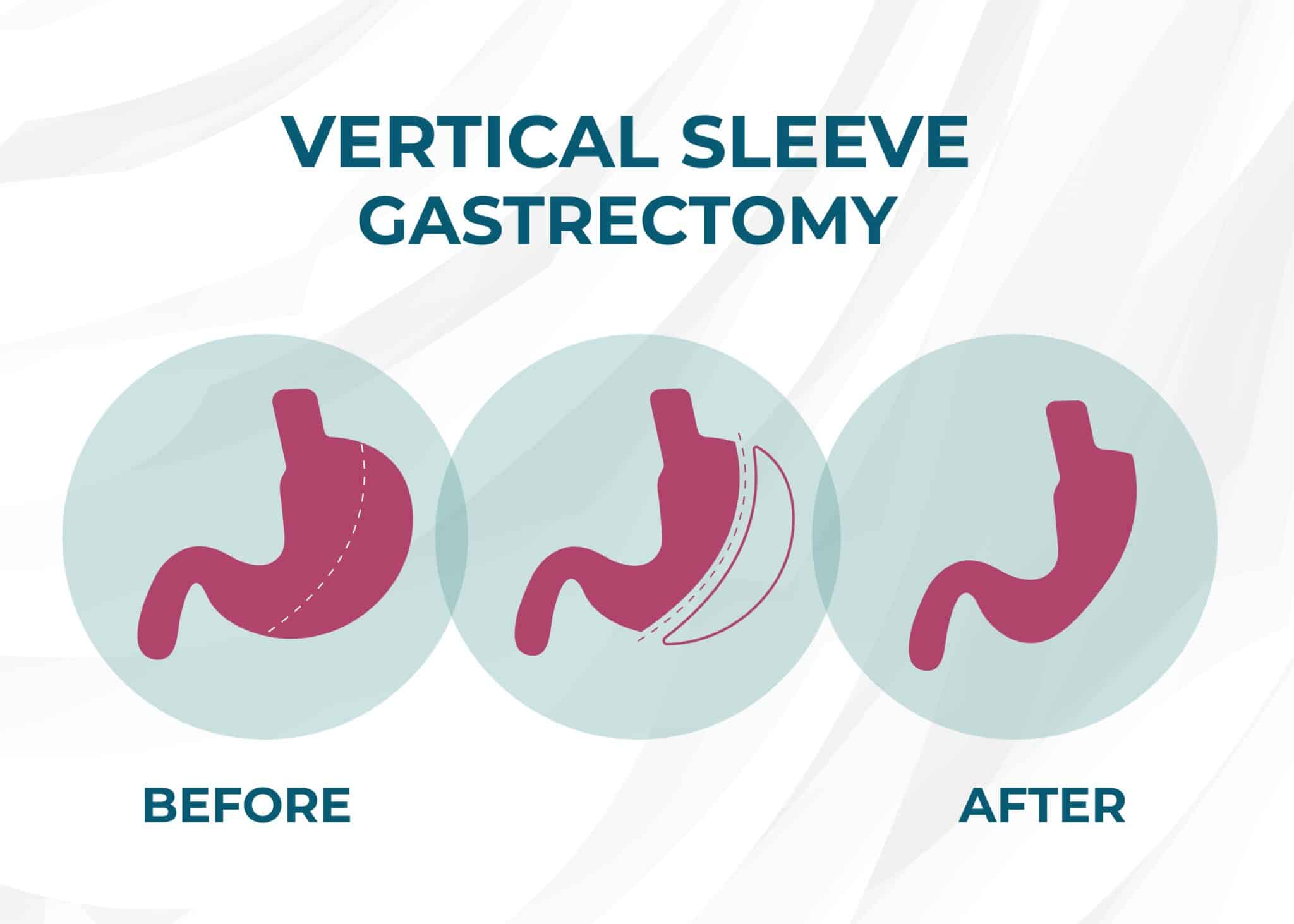 Laparoscopic Sleeve Gastrectomy | Southcoast Health